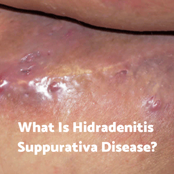 What Is Hidradenitis Suppurativa Disease? | Our Complete Guide